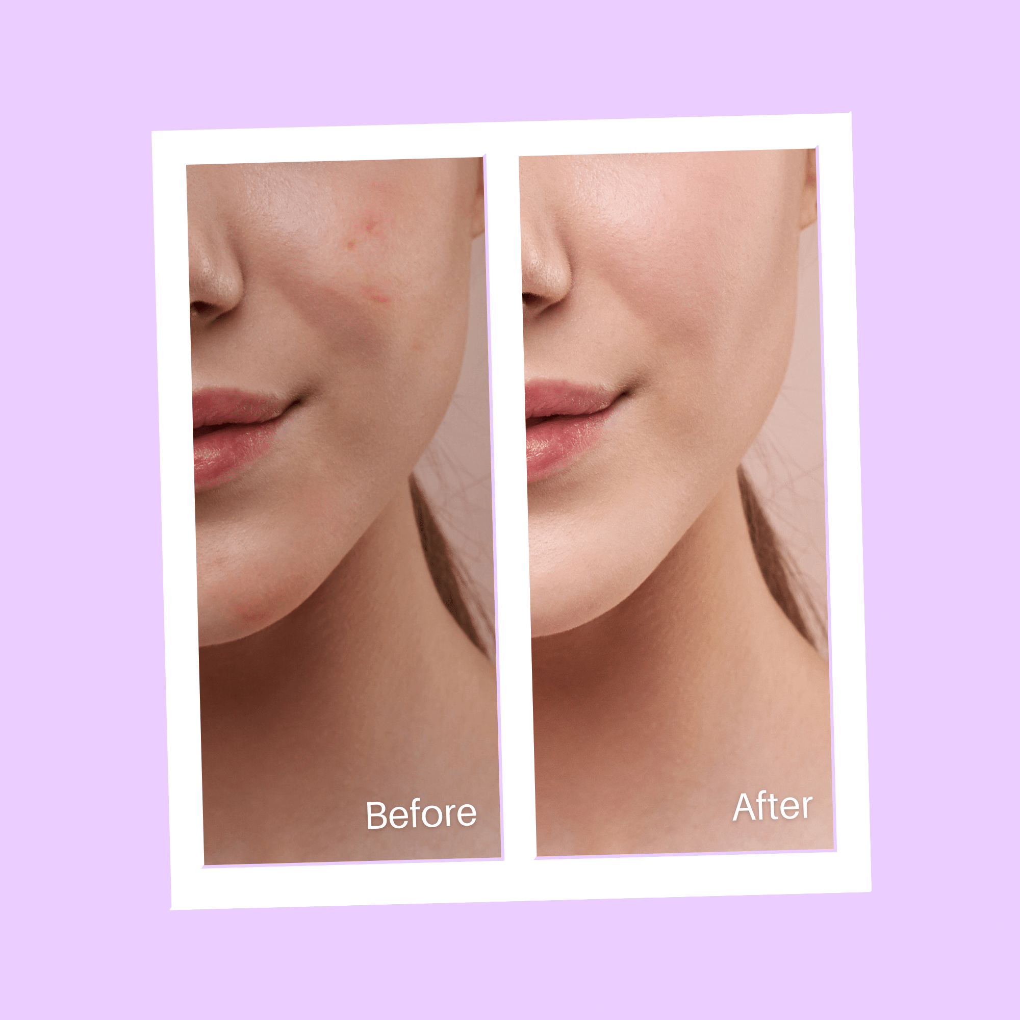 How to Get Rid of Acne: 6 Tips for Clearer Skin – Ecladerm